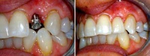 21 Dental Implant Before and After Photos