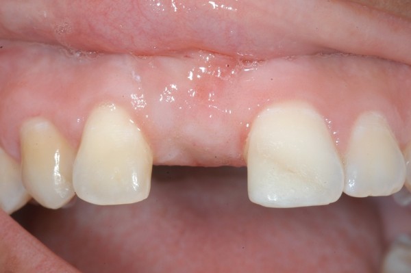 Complete Dental Implant Surgery Guide - What to Expect