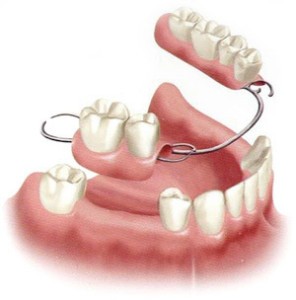 Dental Flipper Teeth: Cost & Benefits