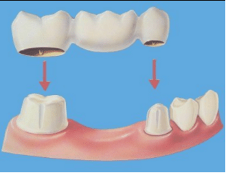 8 Best Tooth Replacement Options for Missing Teeth