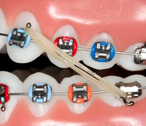 Rubber Bands for Braces Guide